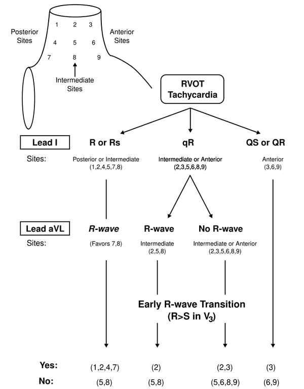 RVOT / LVOT tachycardia - EPpedia