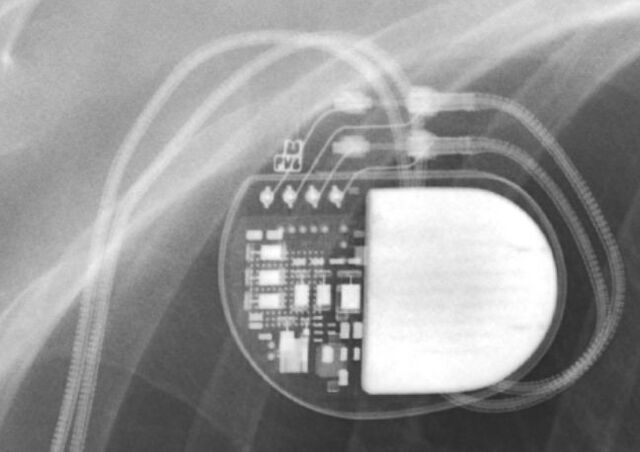 X-ray or radiographic markers of devices - EPpedia