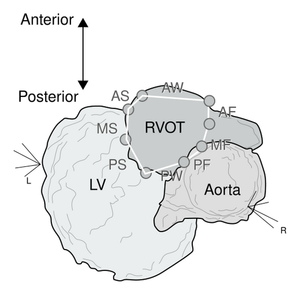 RVOT / LVOT tachycardia - EPpedia