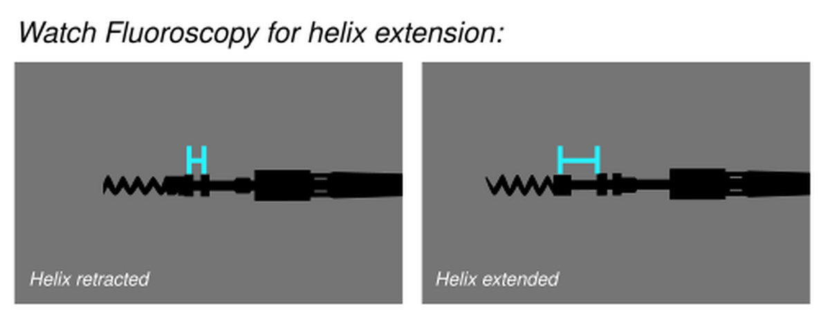 File:Helix-extension 5086-4076 Capsure fix novus.svg - EPpedia